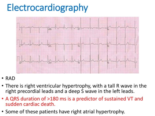 Tetralogy of Fallot (TOF) | PPTX