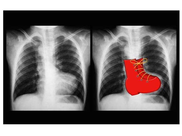 Tetralogy of Fallot (TOF) | PPTX
