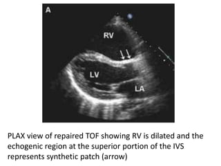 Tetralogy of Fallot (TOF) | PPTX
