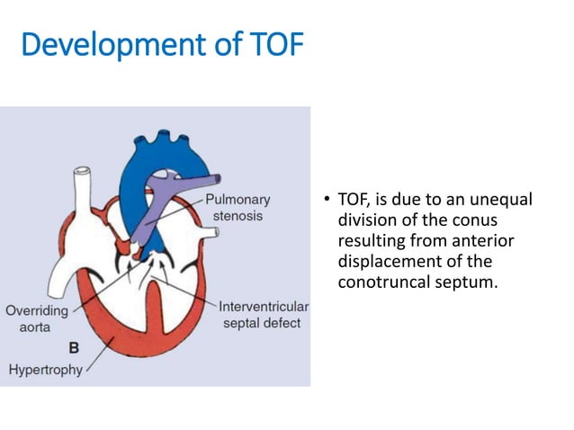 Tetralogy of Fallot (TOF) | PPTX