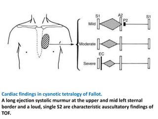 Tetralogy of Fallot (TOF) | PPT