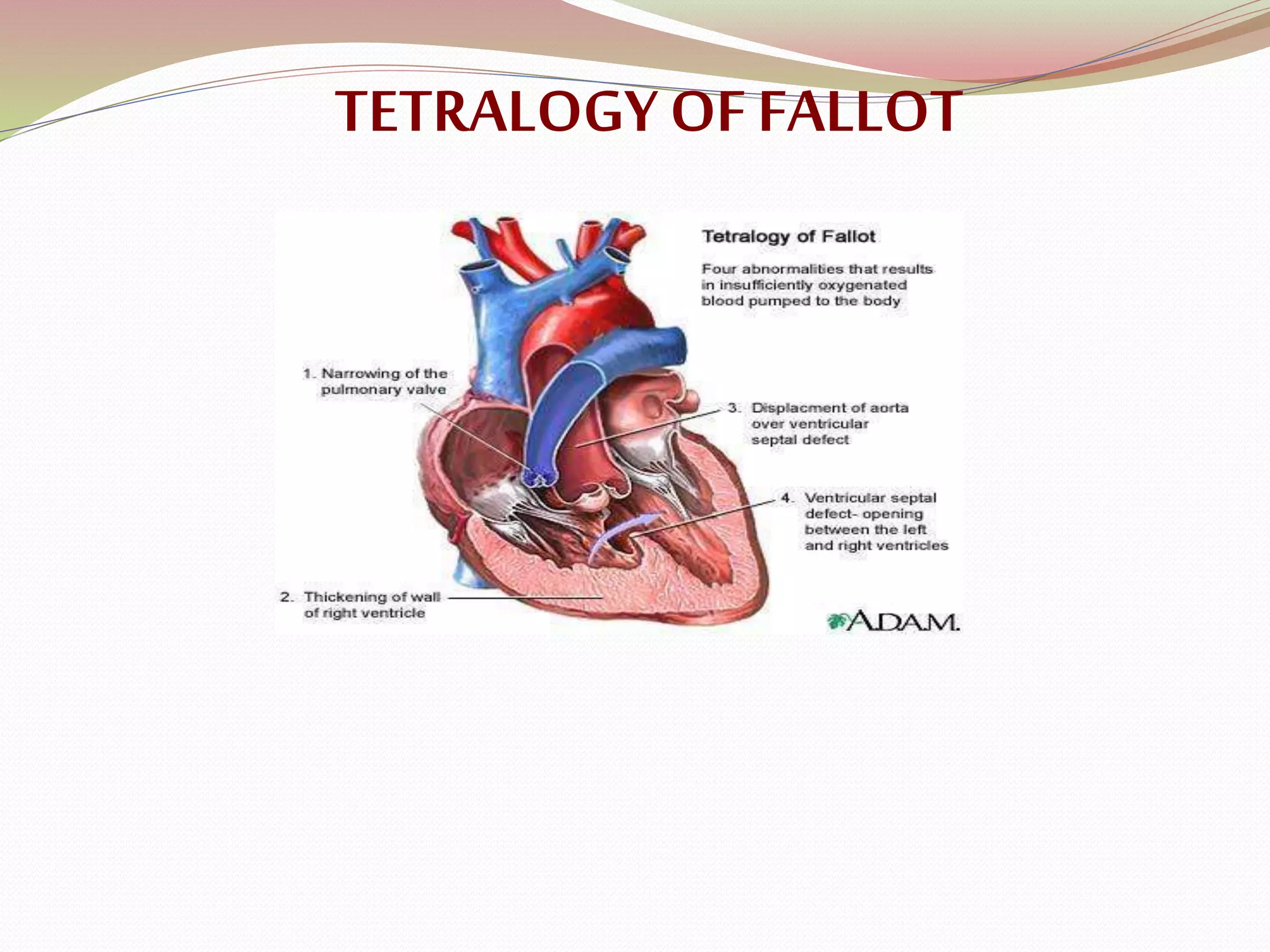 tertalogy of fallot | PPTX