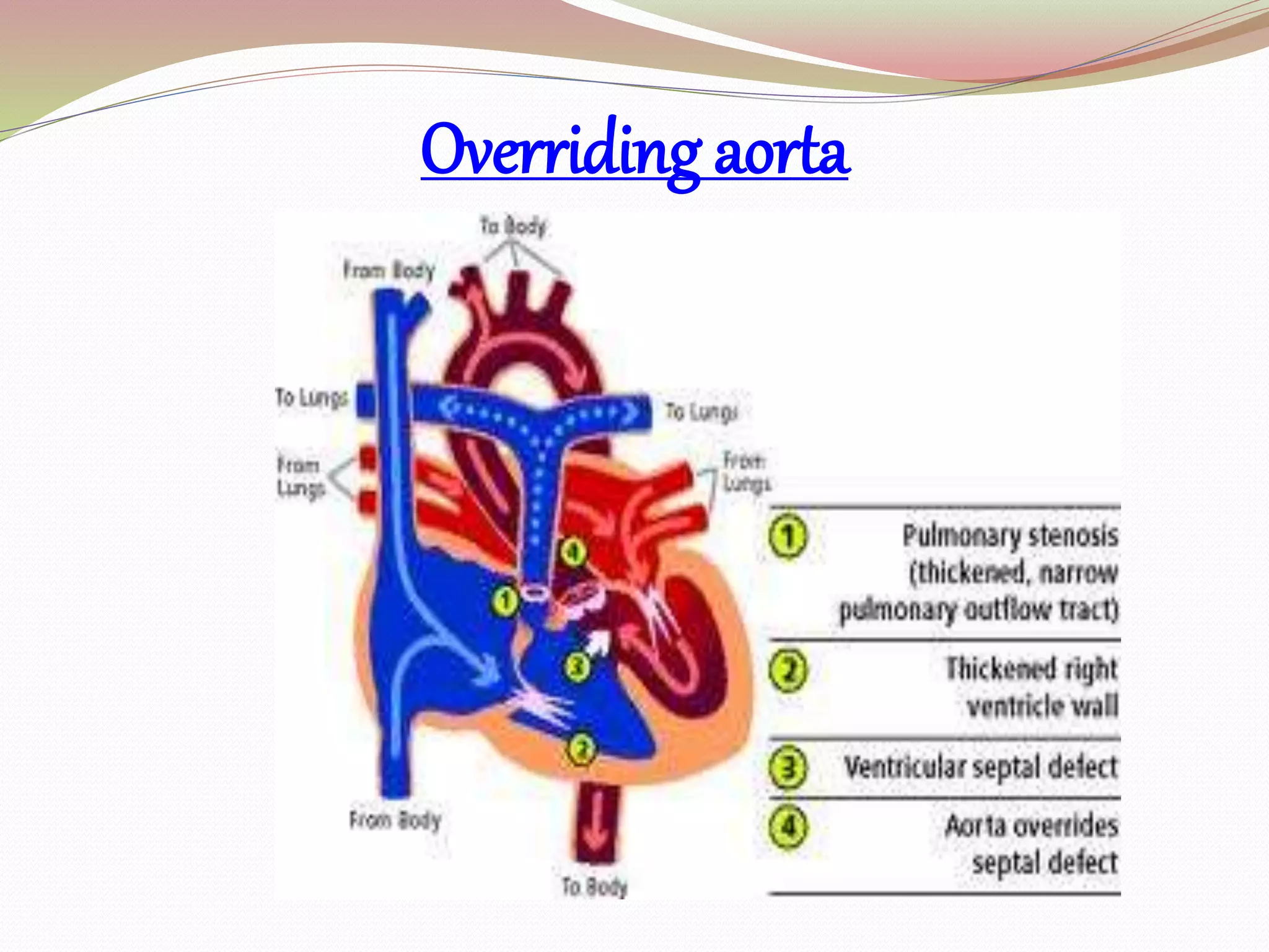 tertalogy of fallot | PPTX