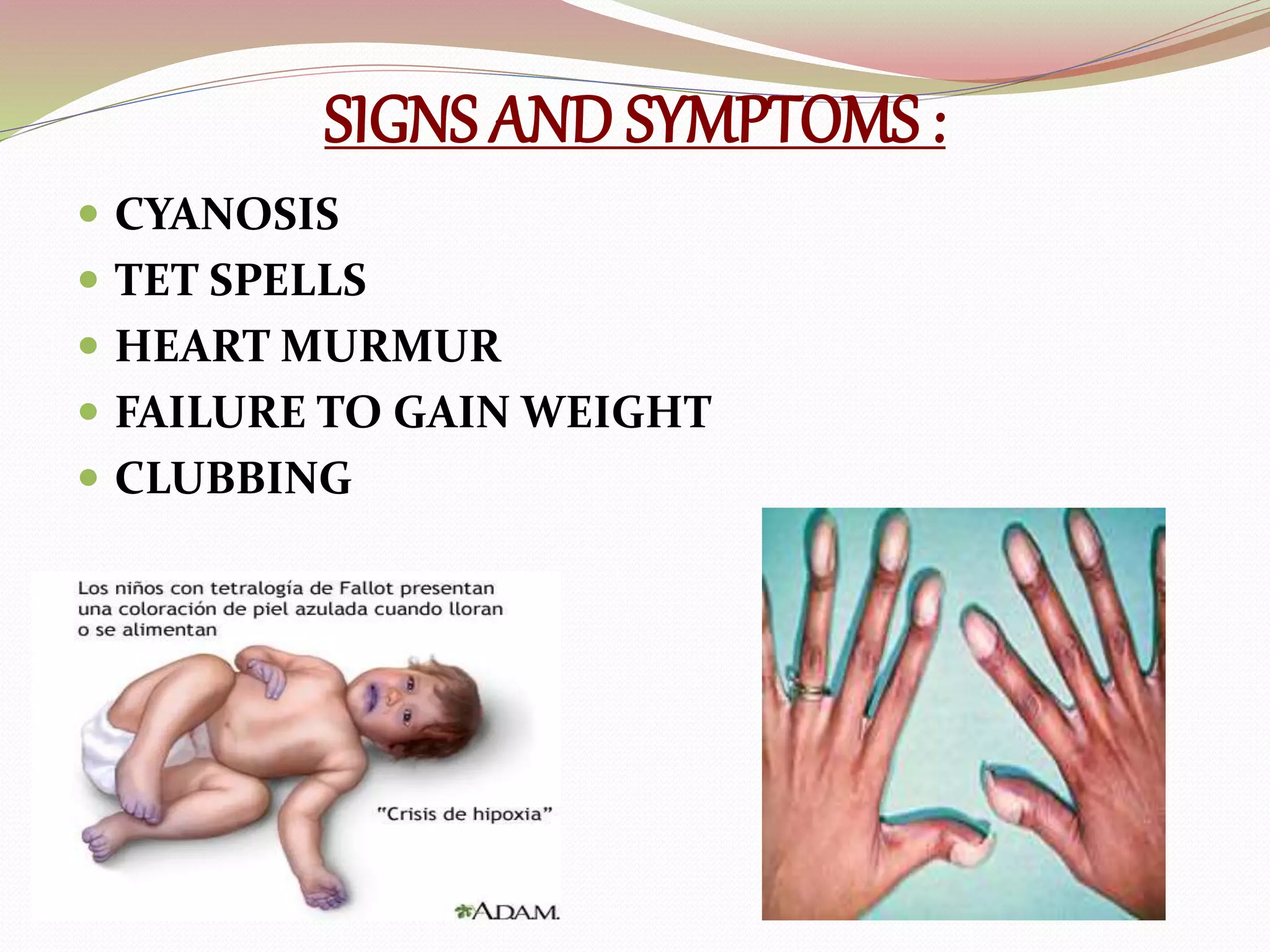 tertalogy of fallot | PPTX