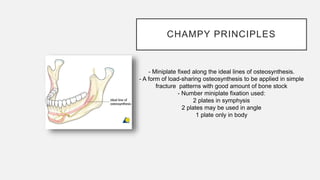 TO fraktur mandibula of oral and maxillofasial surgerypptx | PPTX ...
