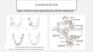 TO fraktur mandibula of oral and maxillofasial surgerypptx | PPTX
