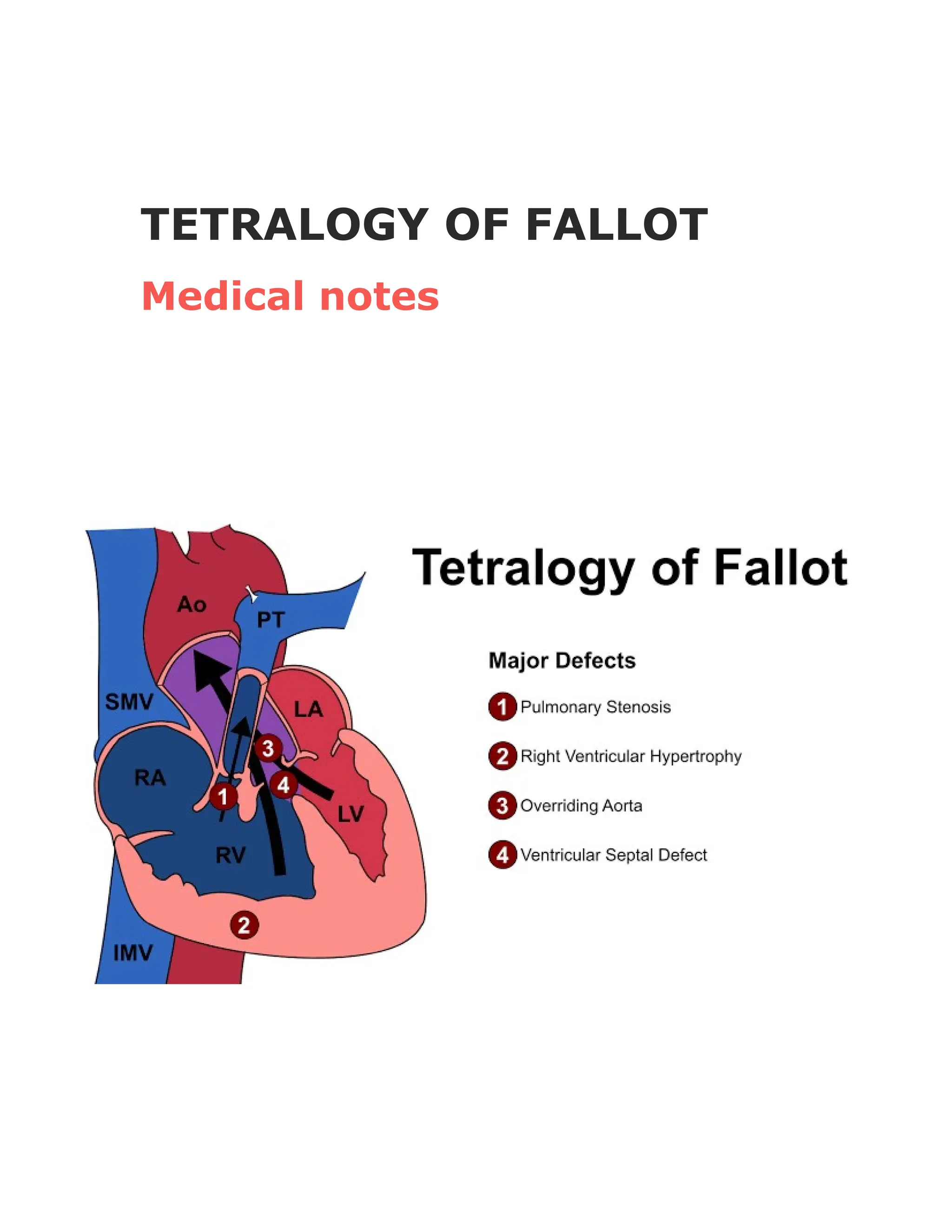 Medical notes on tetralogy of fallot(TOF) | PDF