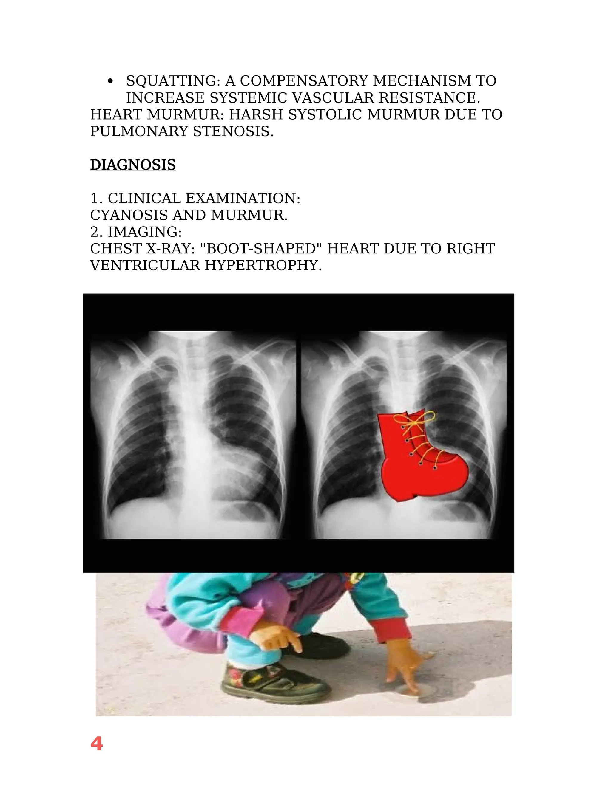Medical notes on tetralogy of fallot(TOF) | PDF
