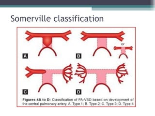 tetrology of fallot (TOF) with pulmonary atresia | PPT