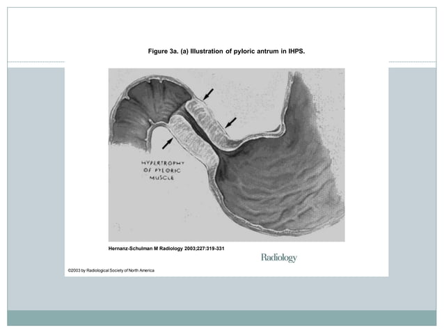 TOK TUGU.Akut abdomen dan ilius pada anak.pptx