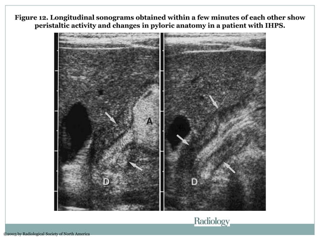 TOK TUGU.Akut abdomen dan ilius pada anak.pptx