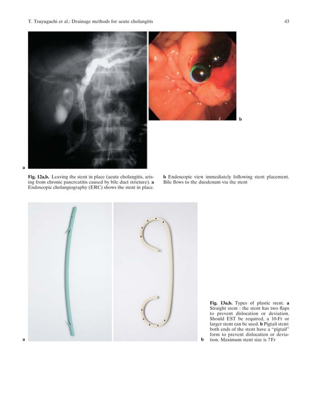 Tokyo guidelines for cholangitis and cholecystitis | PDF | Surgery ...