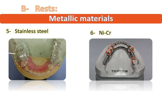 Materials used in RPD construction | PDF | Dental Health | Diseases and ...