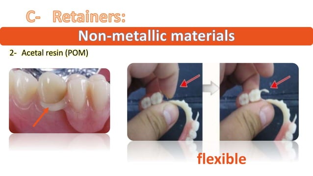 Materials used in RPD construction | PDF | Dental Health | Diseases and ...