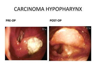 LASER IN ENT | PPTX