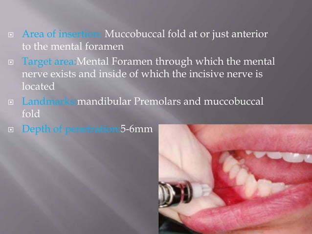 Mandibular injection techniques | PPT