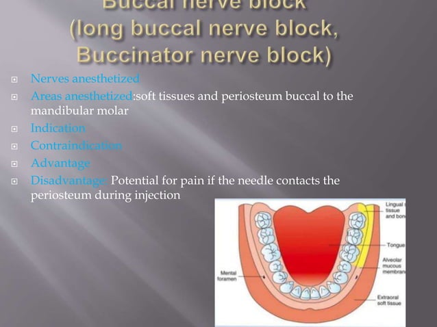 Mandibular injection techniques | PPT