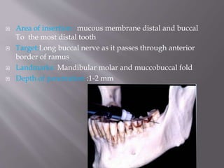 Mandibular injection techniques | PPTX
