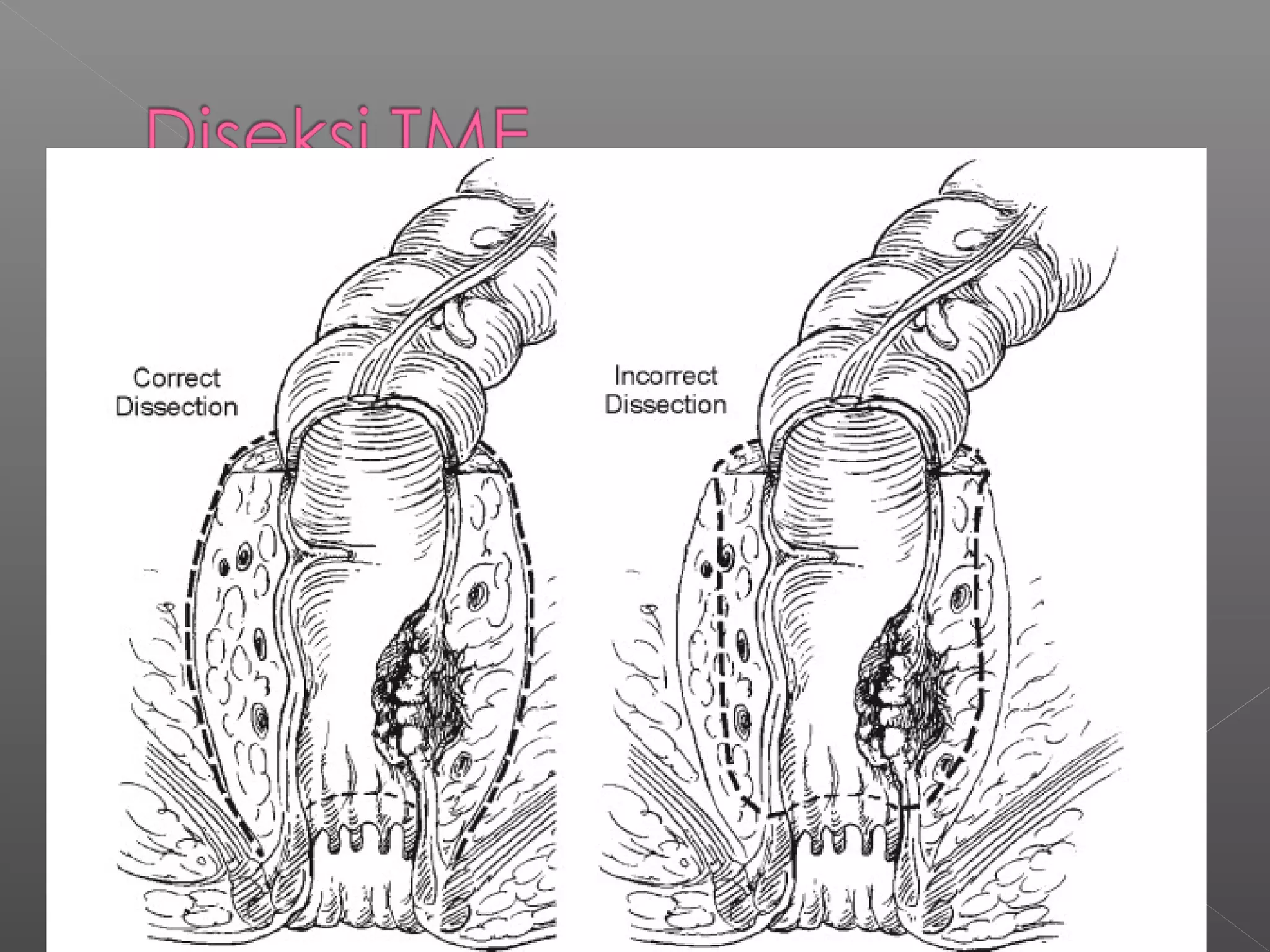 Ca recti Miles operation Abdominalperinealresection | PPT