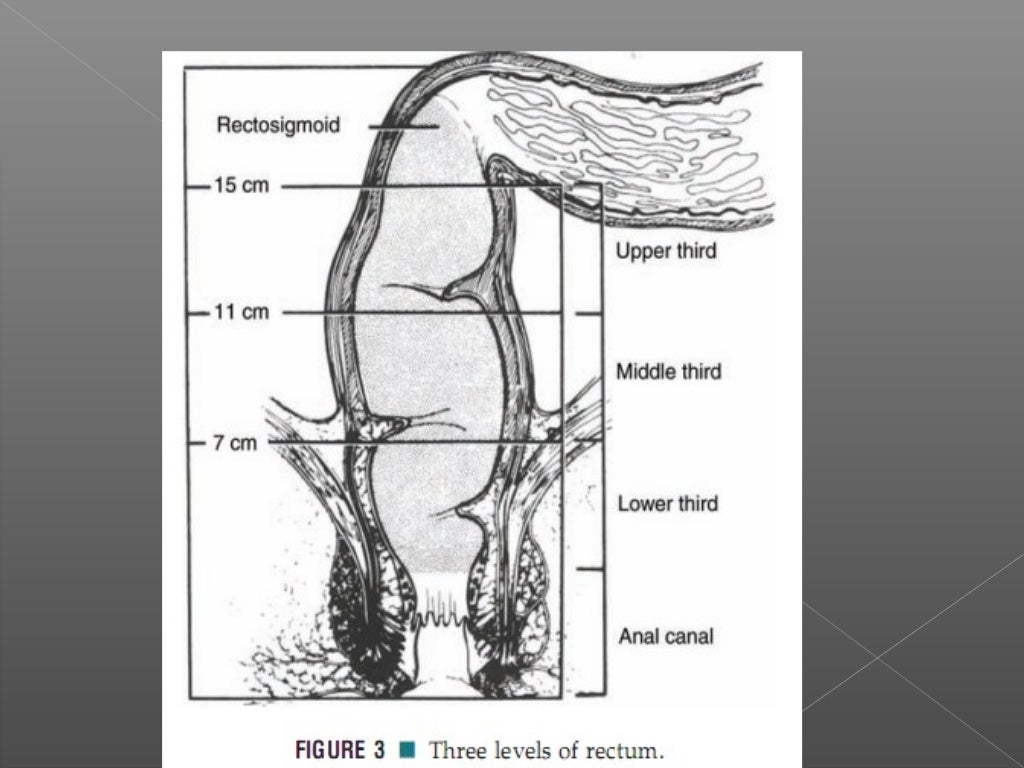 Ca recti Miles operation Abdominalperinealresection