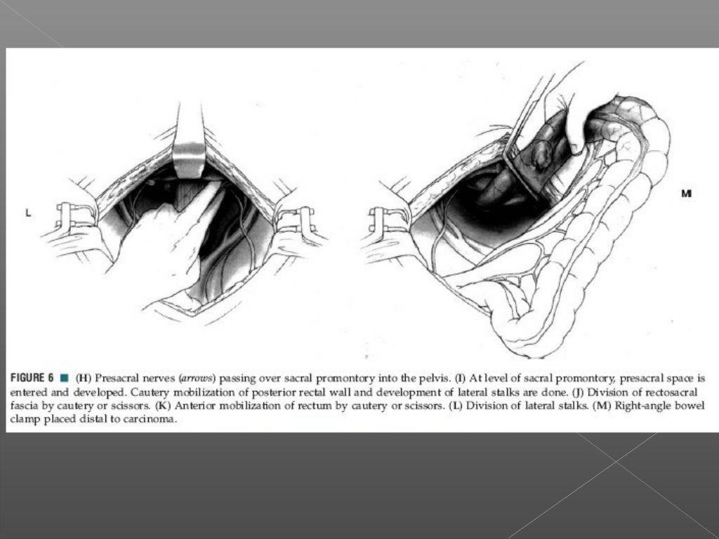 Ca recti Miles operation Abdominalperinealresection