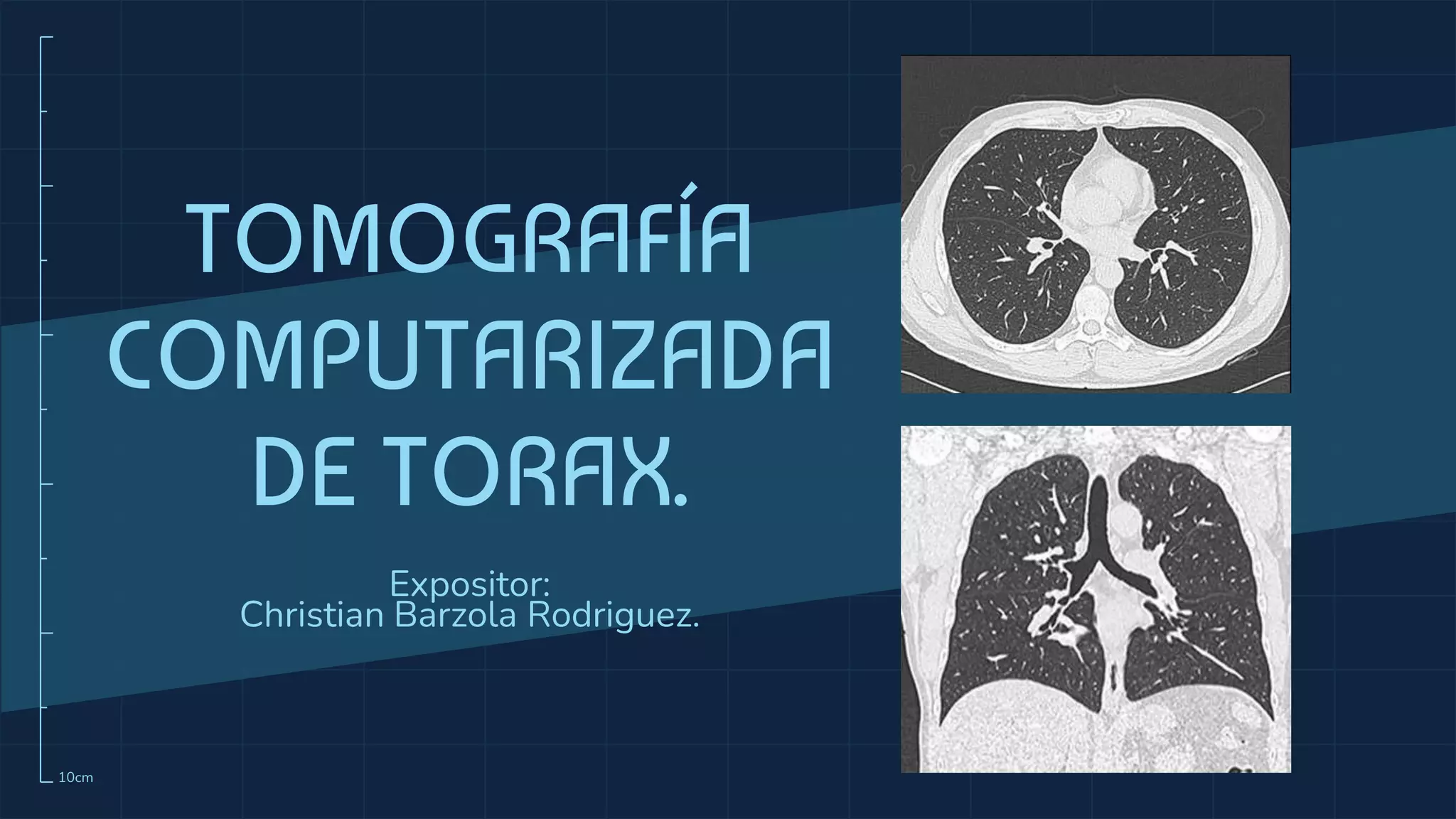 Tomografía computarizada de Tórax. Abordaje general | PPTX