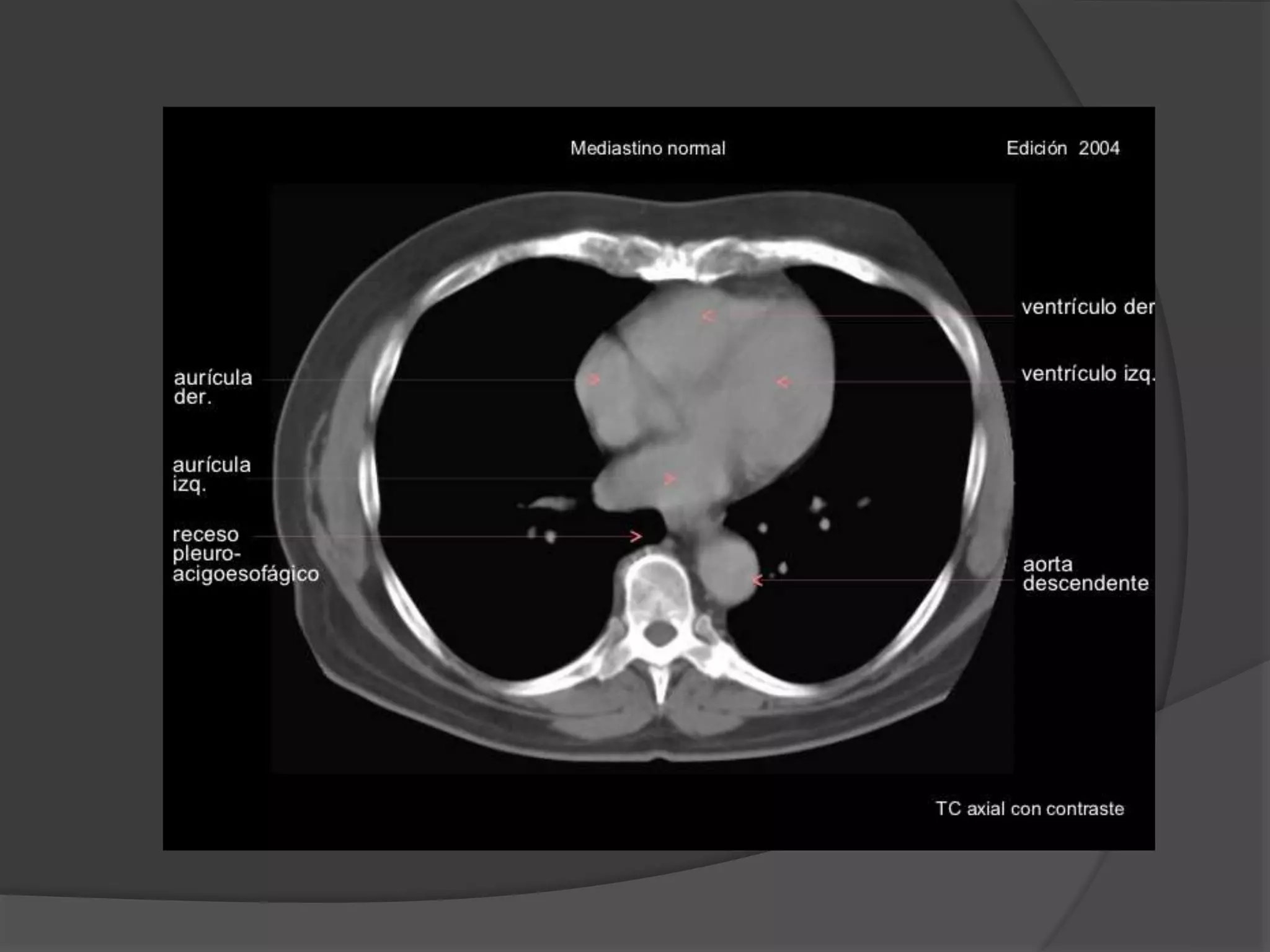 Tomografia anatomia de torax | PPTX