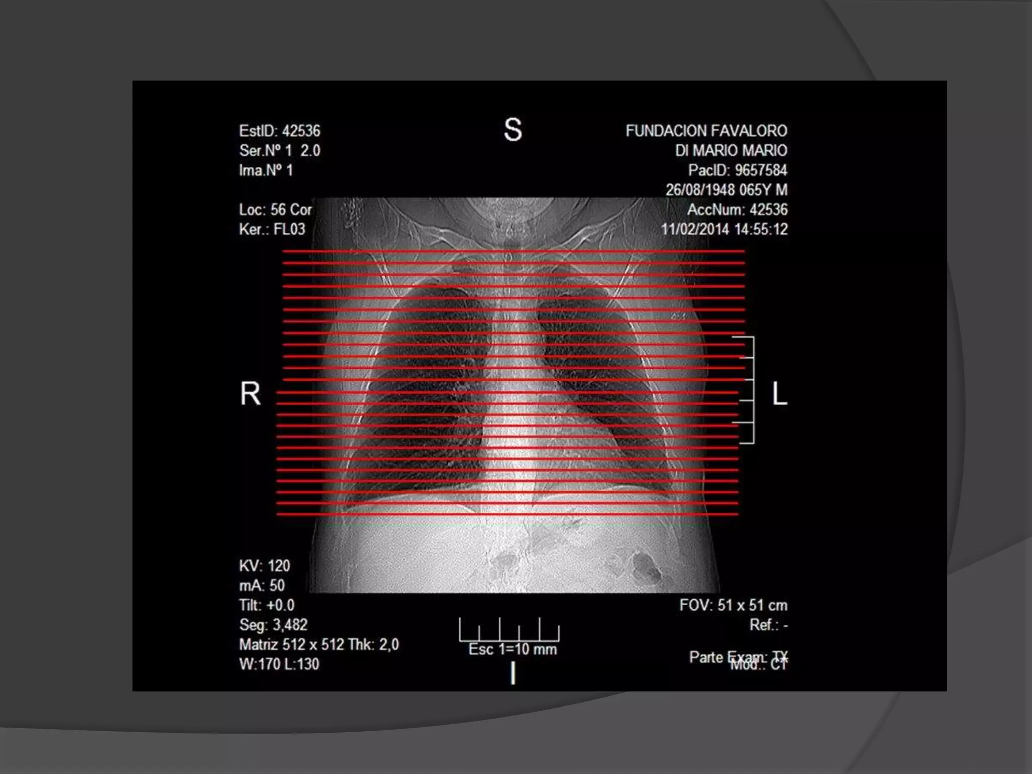 Tomografia anatomia de torax | PPTX