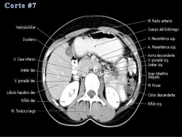 Tomografia axial computarizada (abdominal)