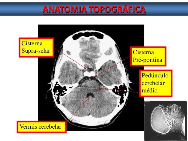 Tomografiacranio1