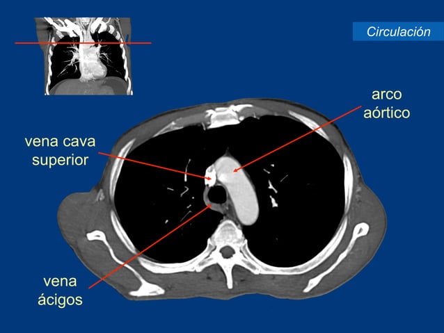 Tomografía de tórax de alta resolución | PPT