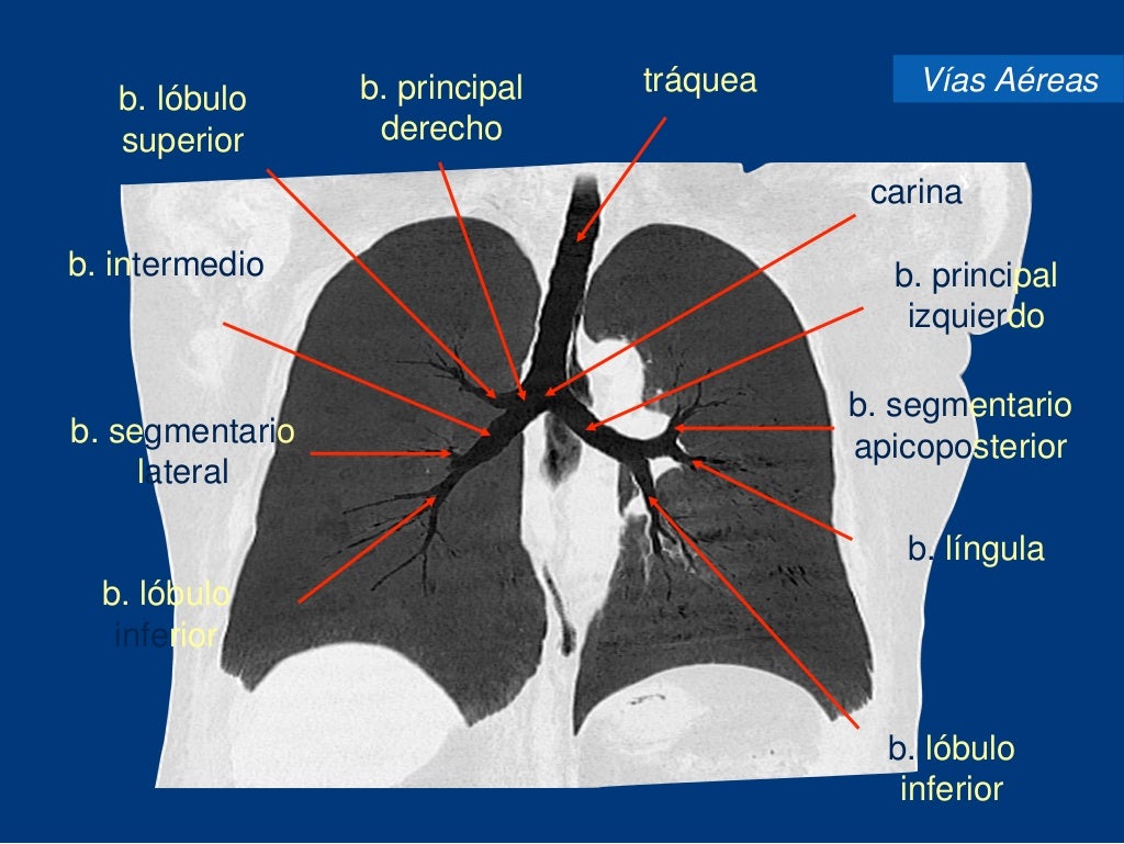 Tomografía de tórax de alta resolución