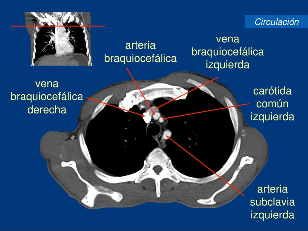 Tomografía de tórax de alta resolución