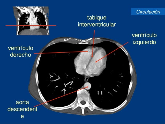 Tomografía de tórax de alta resolución