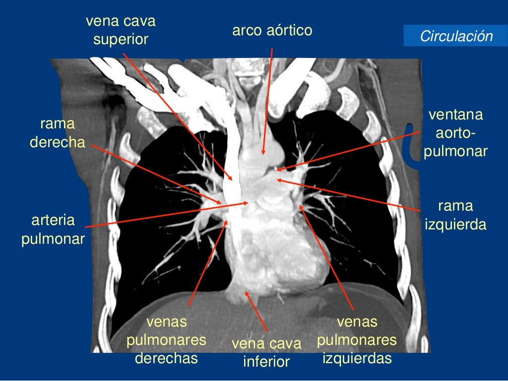 Tomografía de tórax de alta resolución