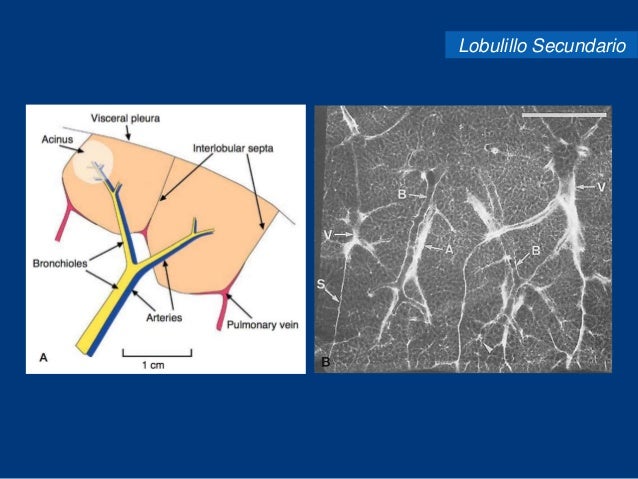 Tomografía de tórax de alta resolución