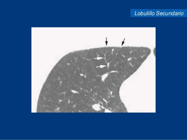 Tomografía de tórax de alta resolución