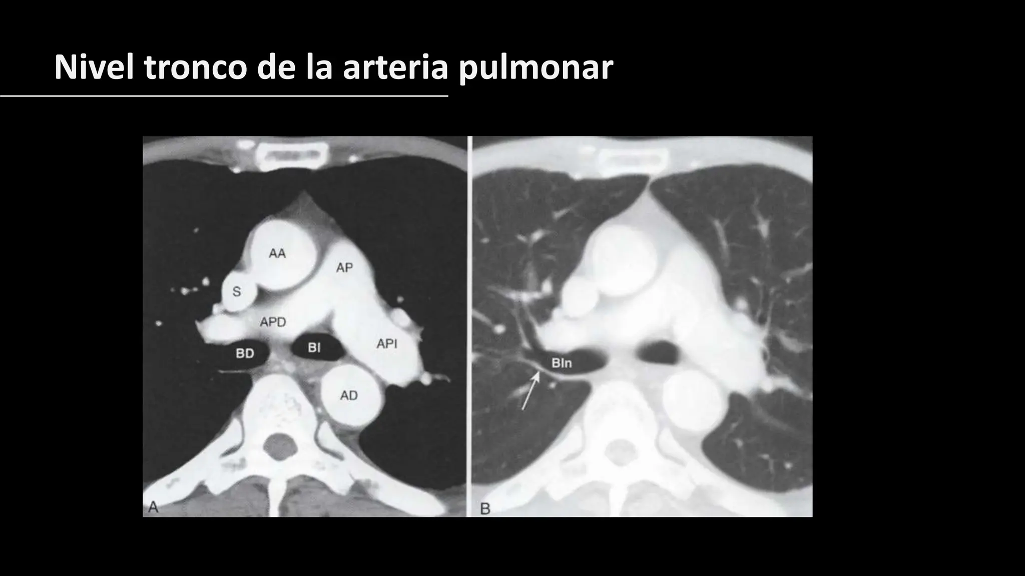 Tomografía de tórax normal Diapositivas.pptx