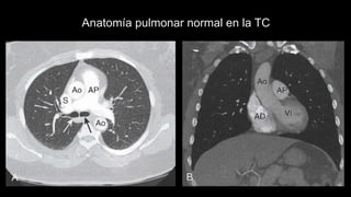 Tomografía de tórax normal Diapositivas.pptx