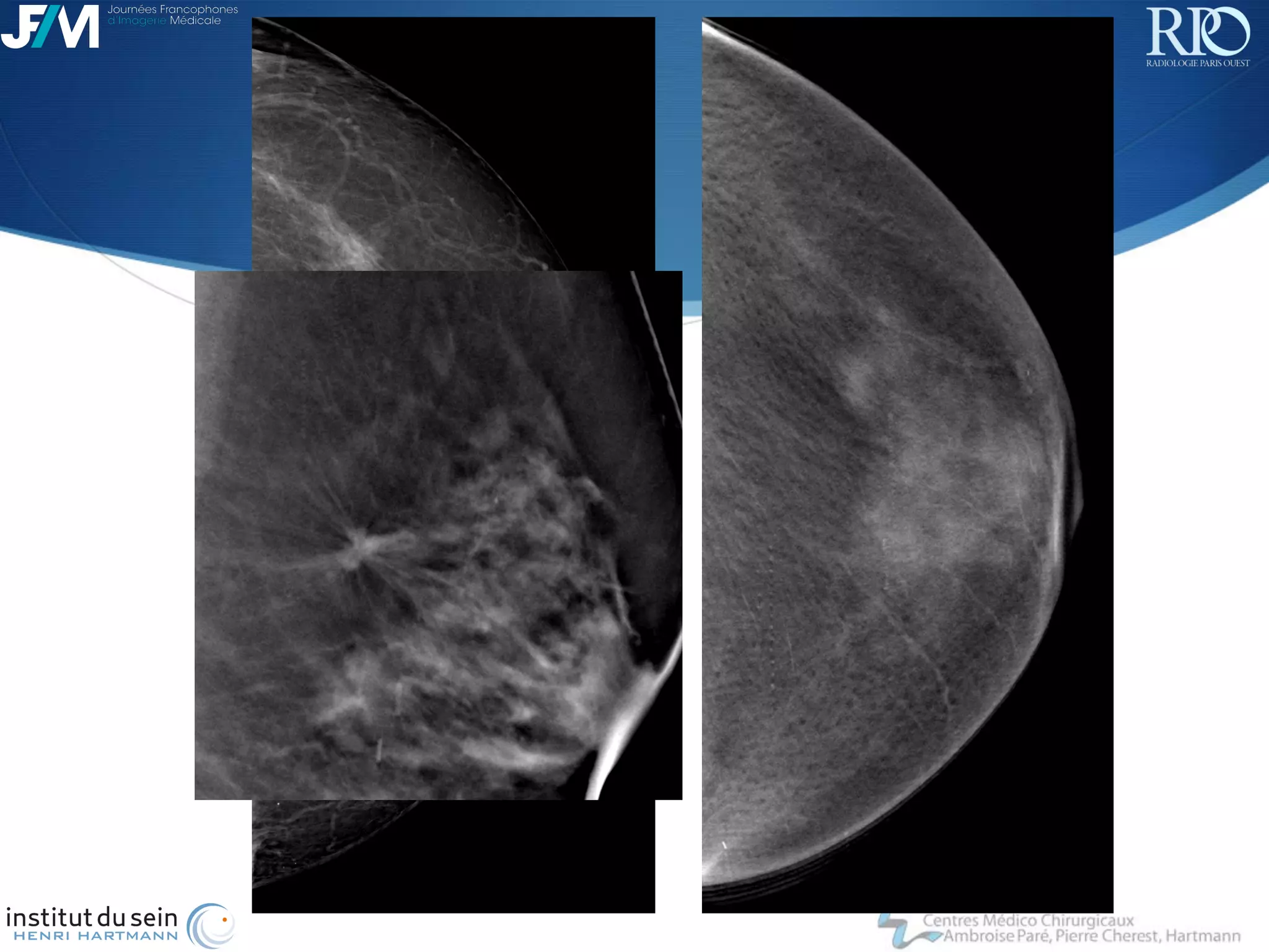 Luc Rotenberg, Tomosynthese et densité mammaire 2015 | PDF