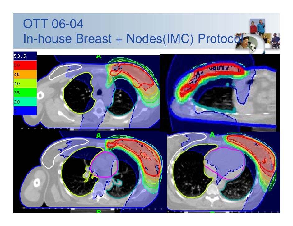 Tomotherapy Based Image Guided Imrt