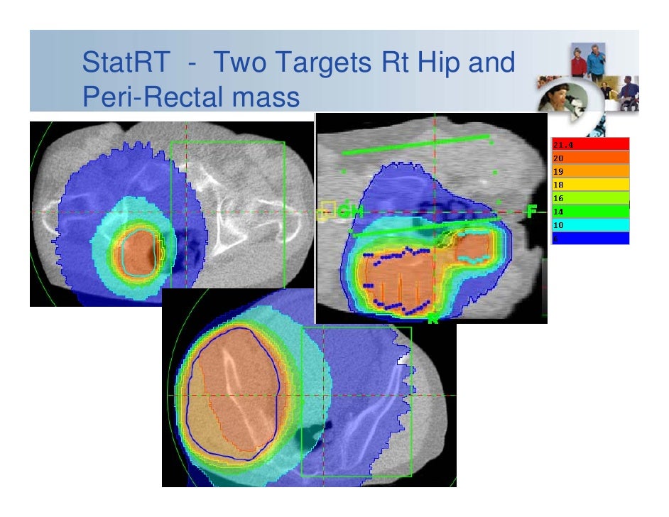 Tomotherapy Based Image Guided Imrt