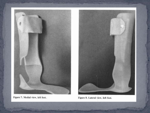 Tone reducing orthosis | PPTX | Death, Injury, or Military Conflict ...