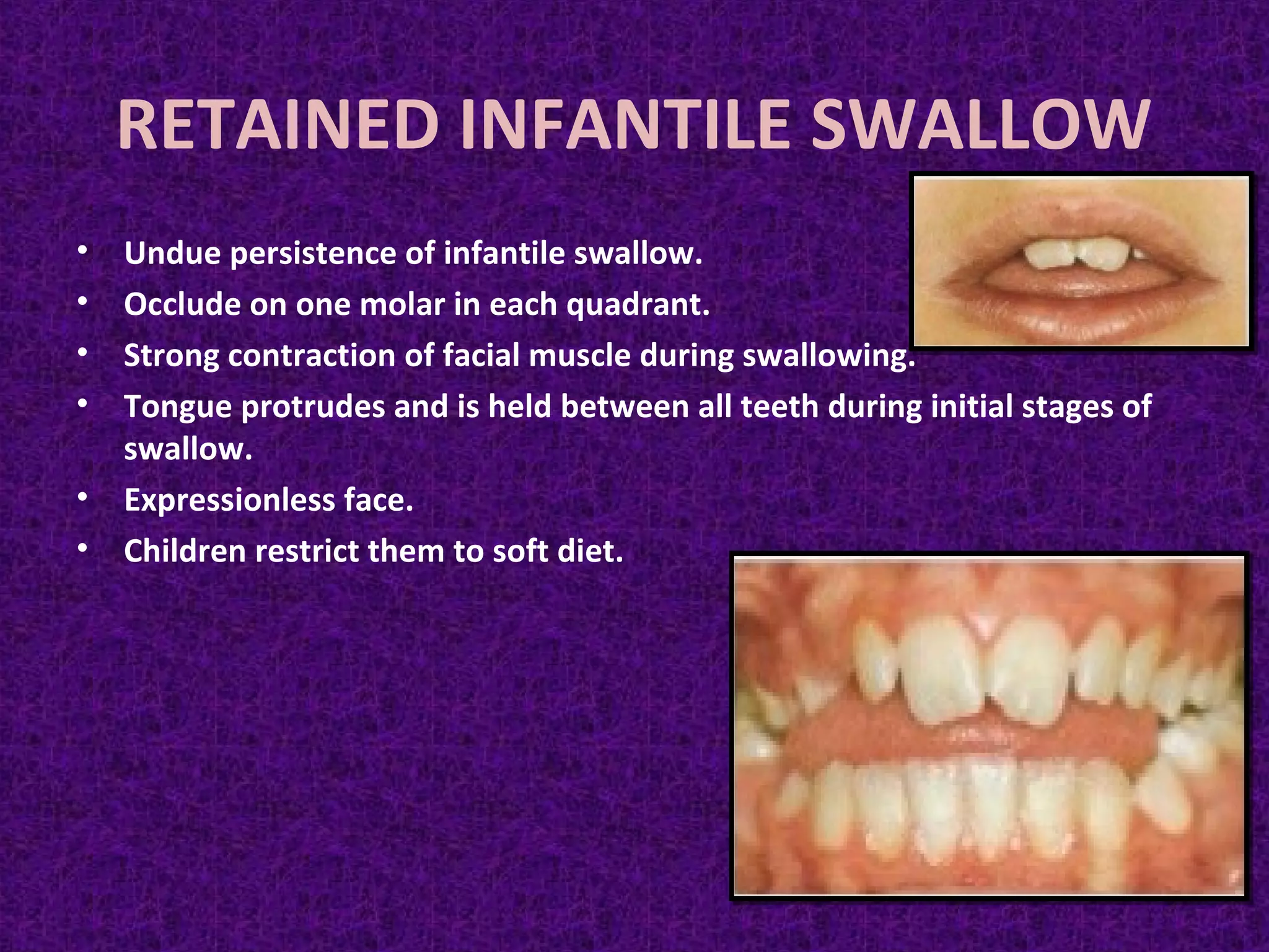 Tongue thrusting - Dr. TALAT NAZ | PPT