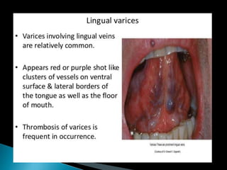 Lingual Varicosities