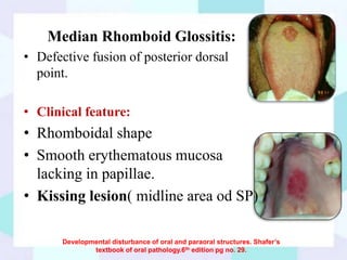 Median Rhomboid Glossitis Kissing Lesion