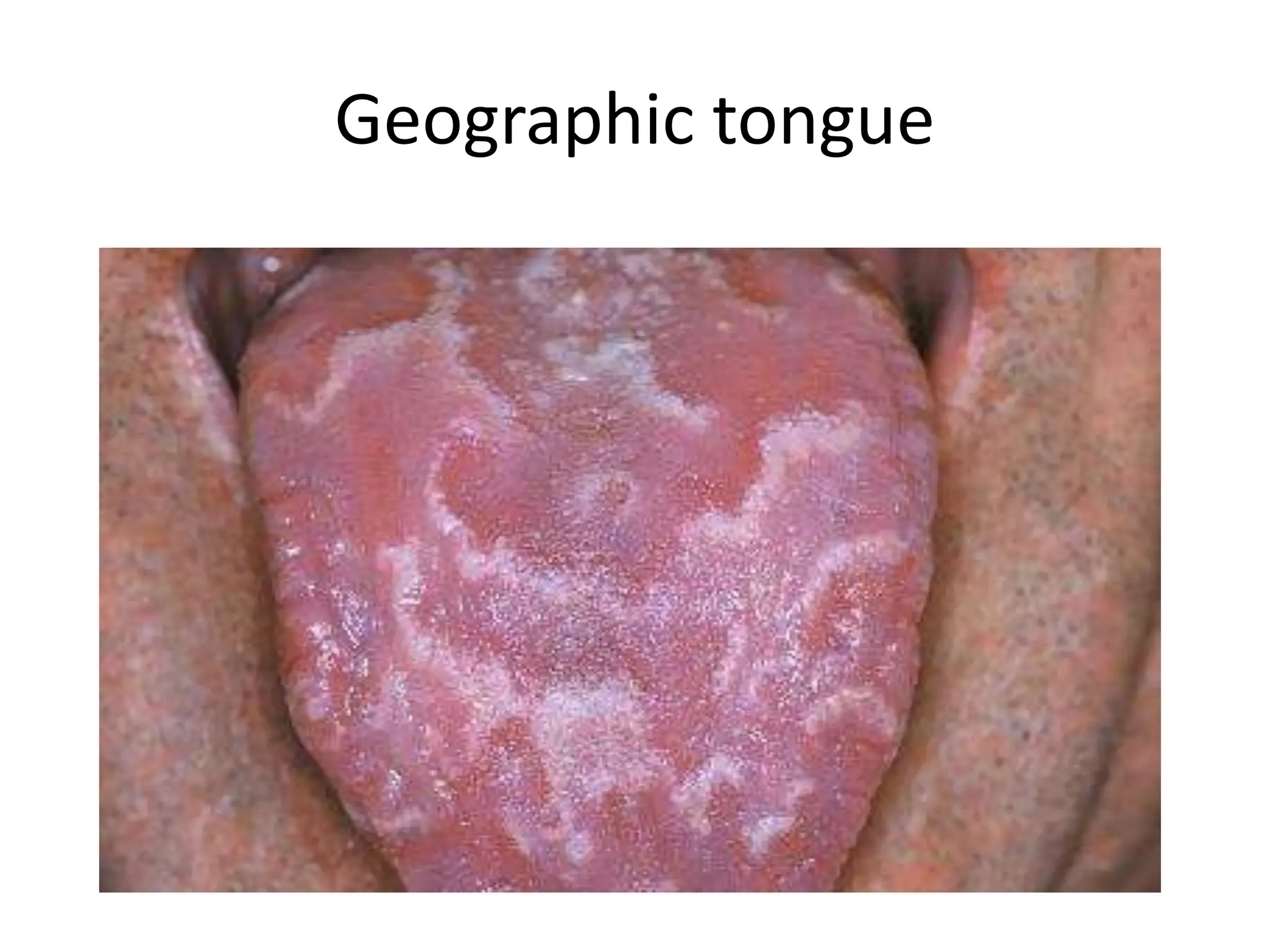 Tongue in health and disease | PPTX