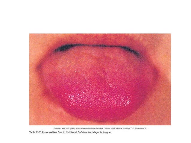 Tongue in health and disease | PPTX | Ear, Nose and Throat Conditions ...