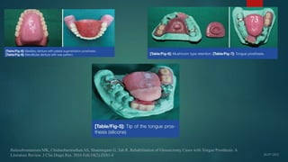 Tongue and it's Prosthodontics Importance | PPTX