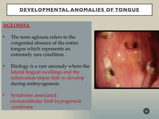 tongue and its prosthodontic considerations | PPTX